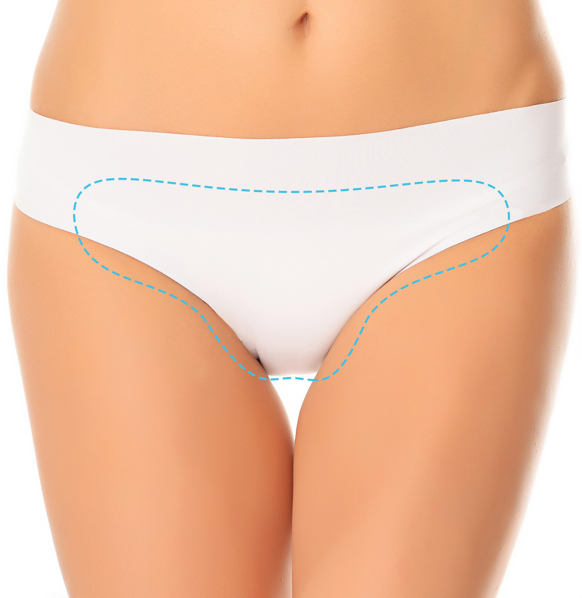 Все про эпиляцию бикини | Клиника "Отражение"