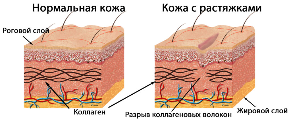 Атрофический рубец - причины и лечение, как убрать рубцы -Клиника ...